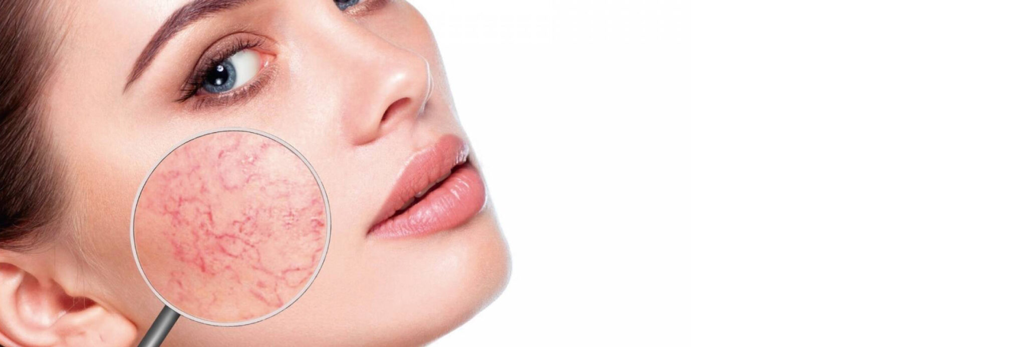 Couperose – Cleyo skin experts schoonheidssalon – huidinstituut